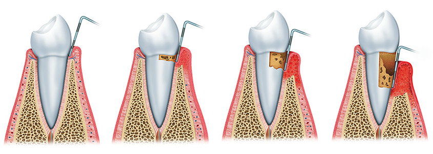 Periodontitis: symptoms and treatments - Sanident