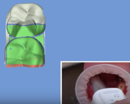 Intraoral digital scanner: very high precision dental impressions