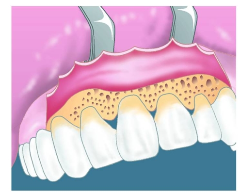 Periodontal pocket: how to heal with the curettage technique
