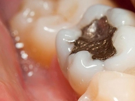 Devitalized tooth: what problems could arise