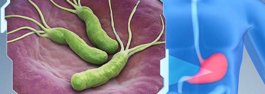 Helicobacter pylori: gastritis and tooth infection | Sanident
