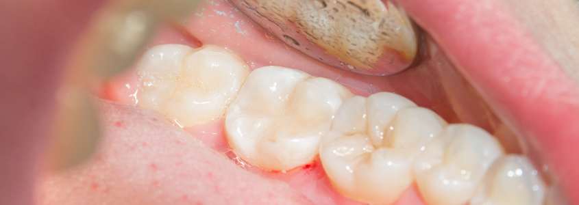 The signs of amalgam or metal on the gums: how to remove them | Sanident